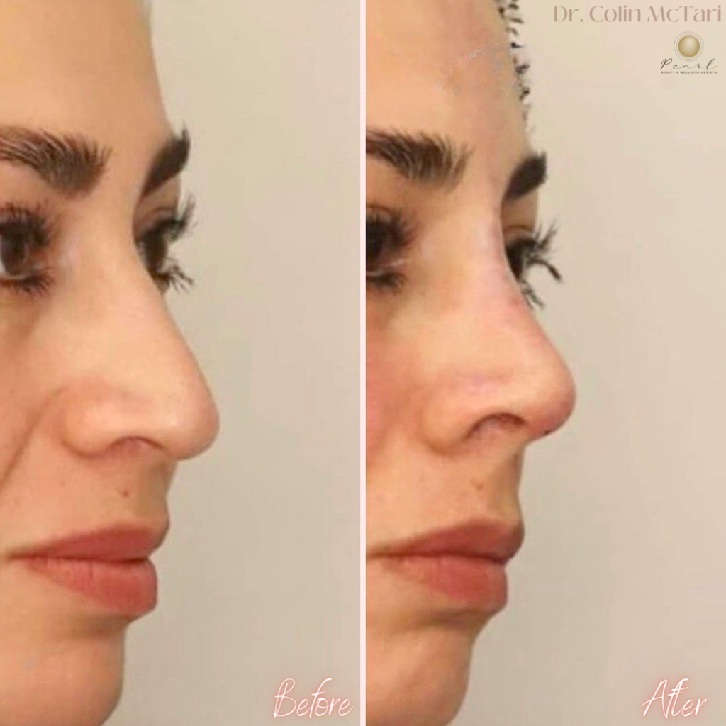 PDO Thread Lift | Nose & Eye Thread, Mono Threads, Thread Face Lift