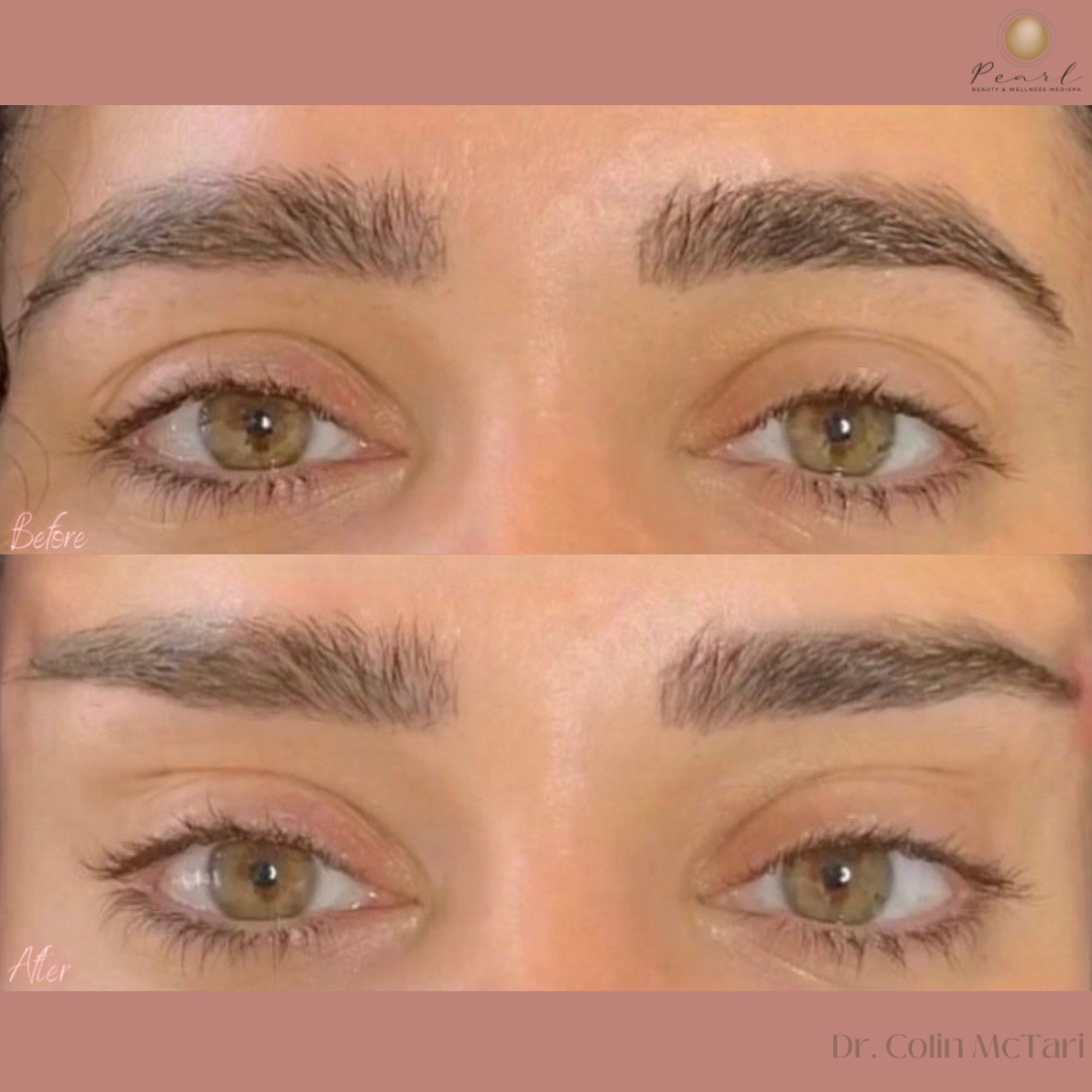 PDO Thread Lift | Nose & Eye Thread, Mono Threads, Thread Face Lift