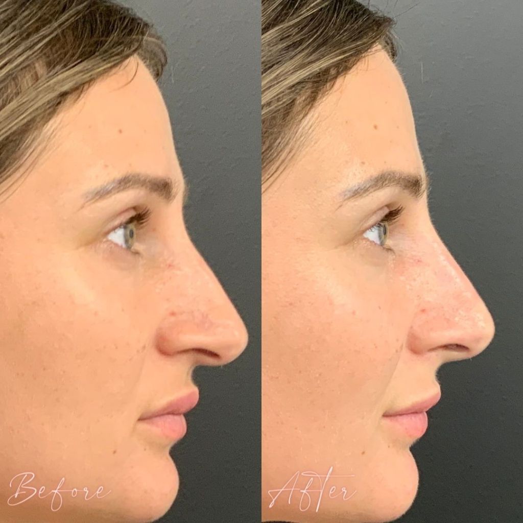 PDO Thread Lift | Nose & Eye Thread, Mono Threads, Thread Face Lift