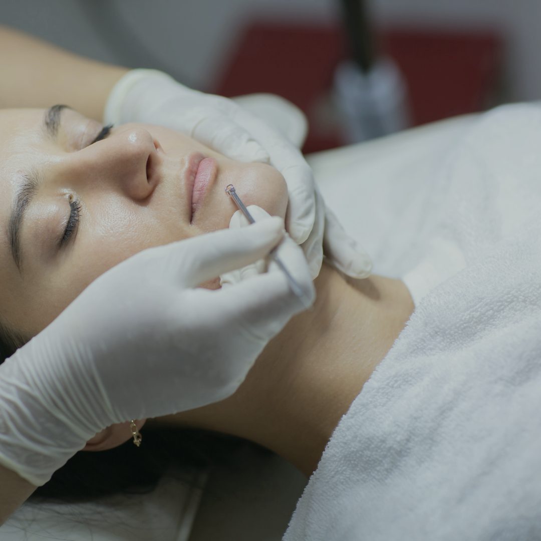 Extraction Facials | Blackhead Extraction, Milia, Pore & Pimple Extraction