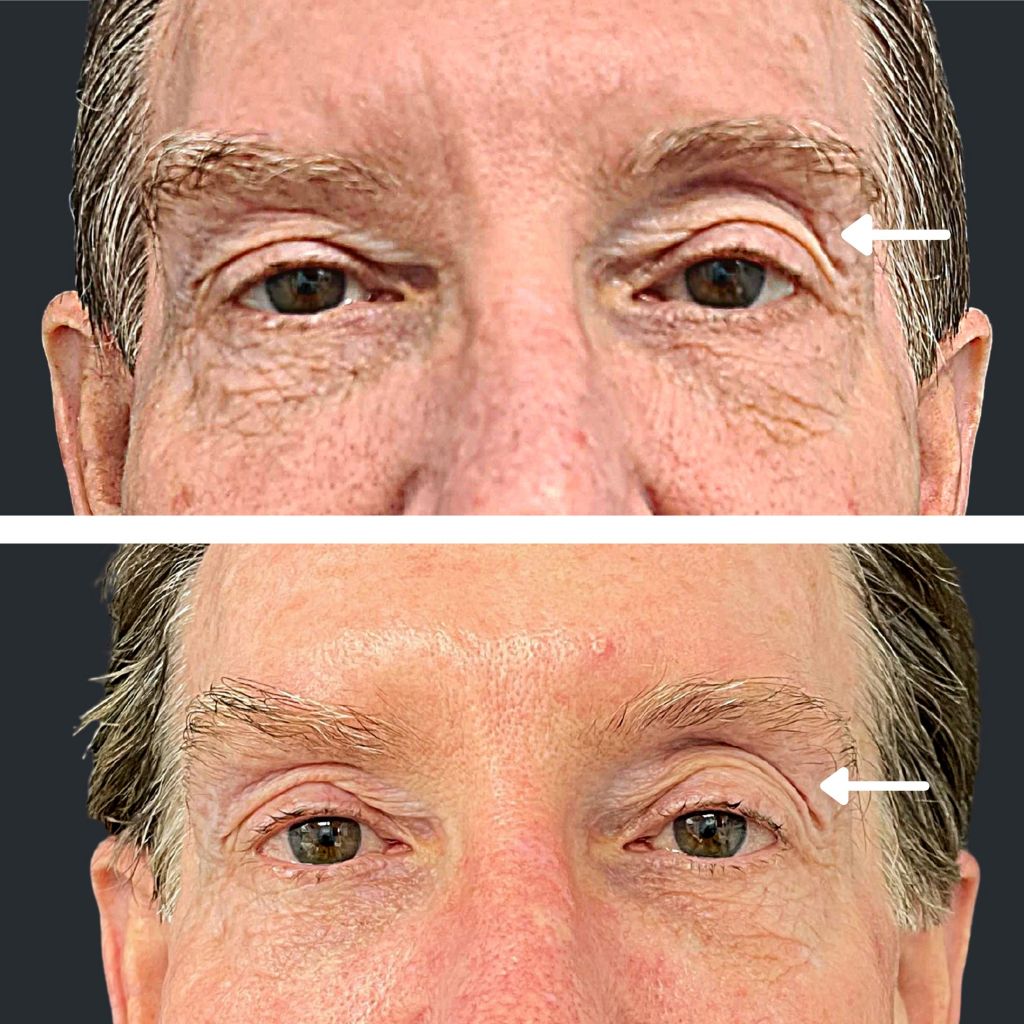 Laser for Eye Wrinkles | CO2, Pico and Tixel Laser for Under-Eye Wrinkles