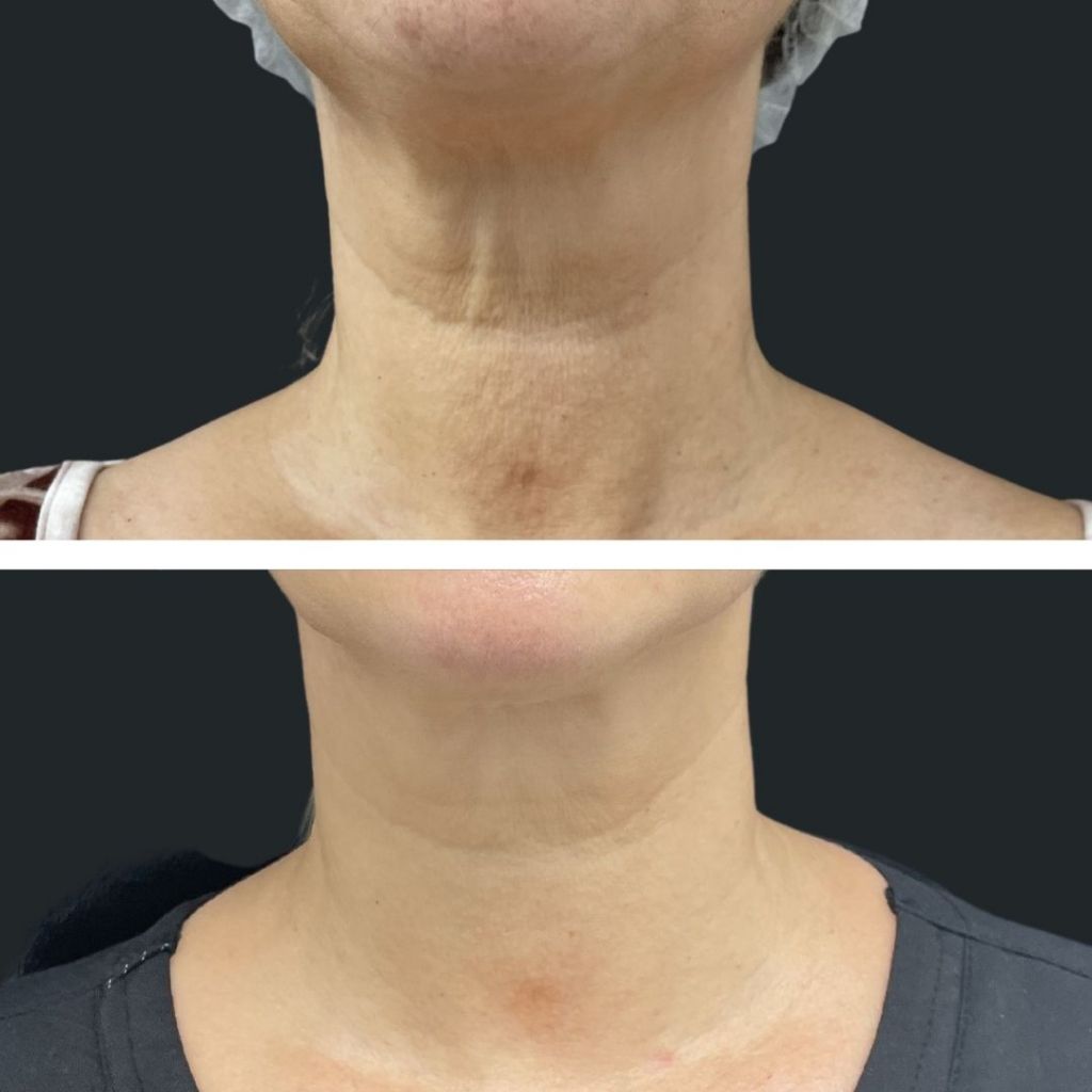 HIFU Treatment 10 - 50% Off | Face, Neck Tummy, Arms, Knees, Thighs