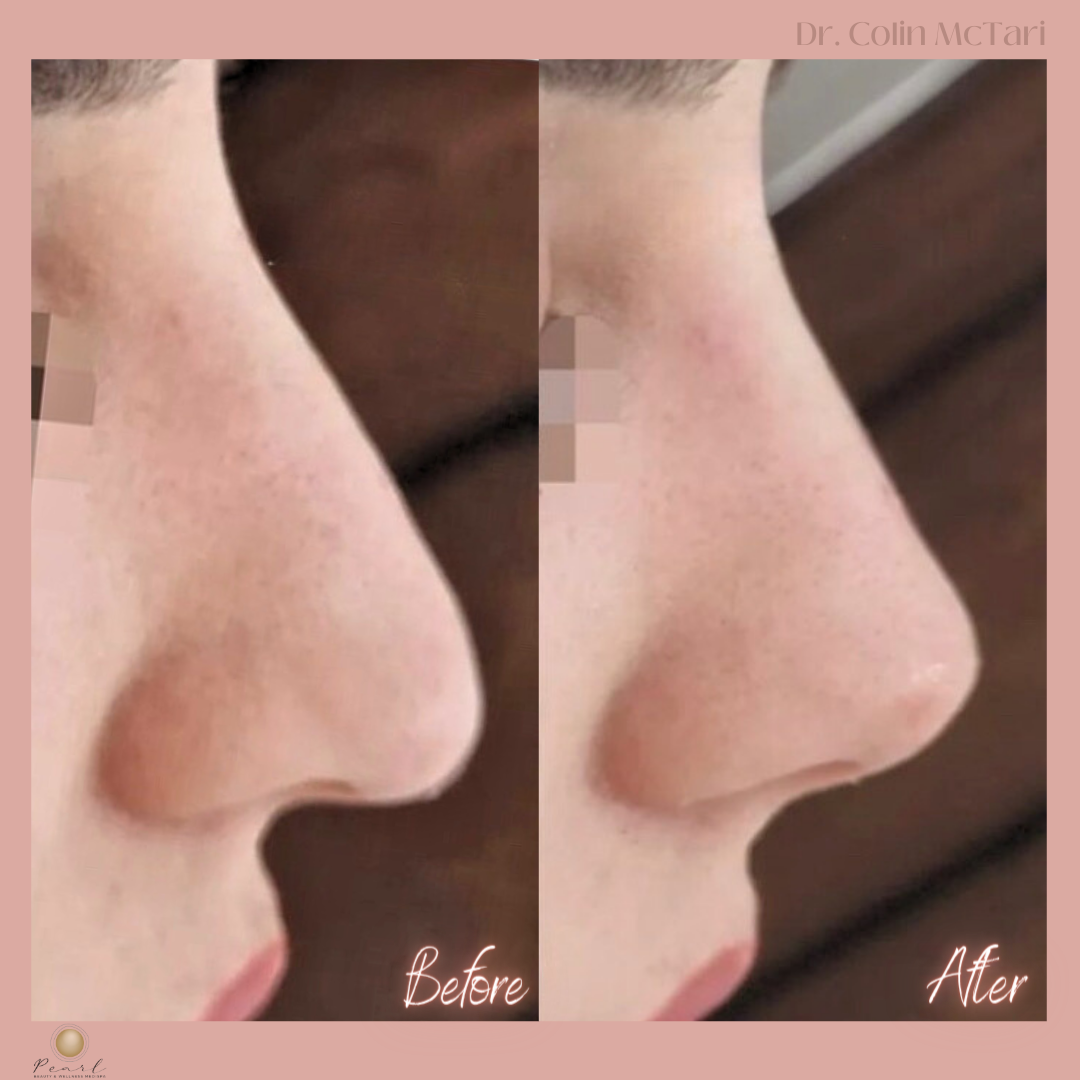 PDO Thread Lift | Nose & Eye Thread, Mono Threads, Thread Face Lift