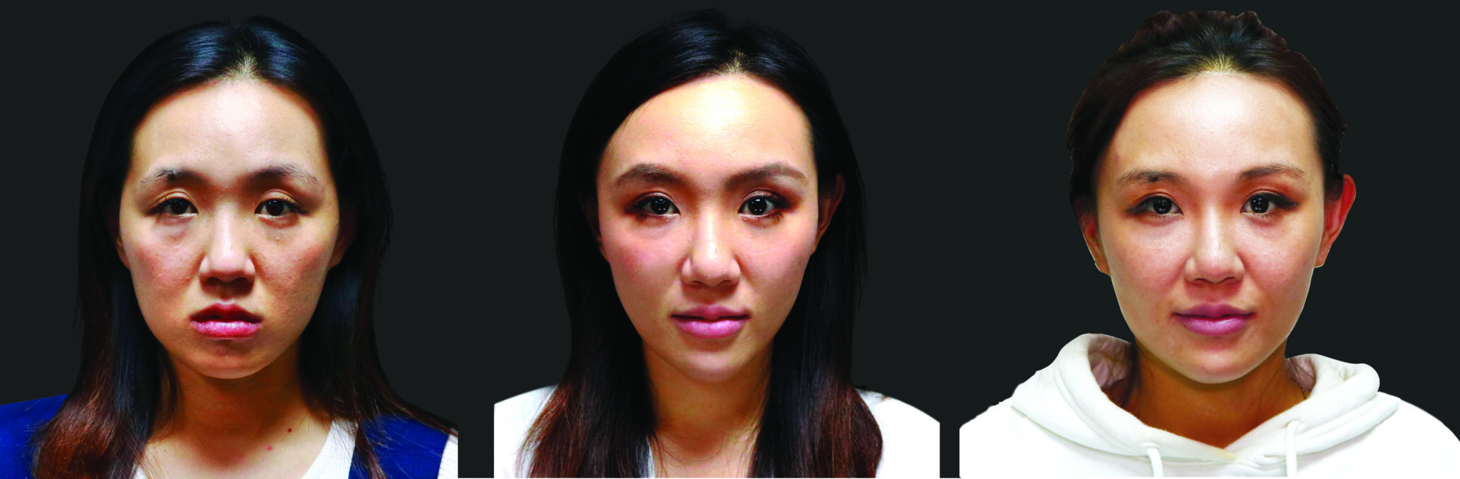 Collagen Stimulating Filler | Biostimulator Filler Injections