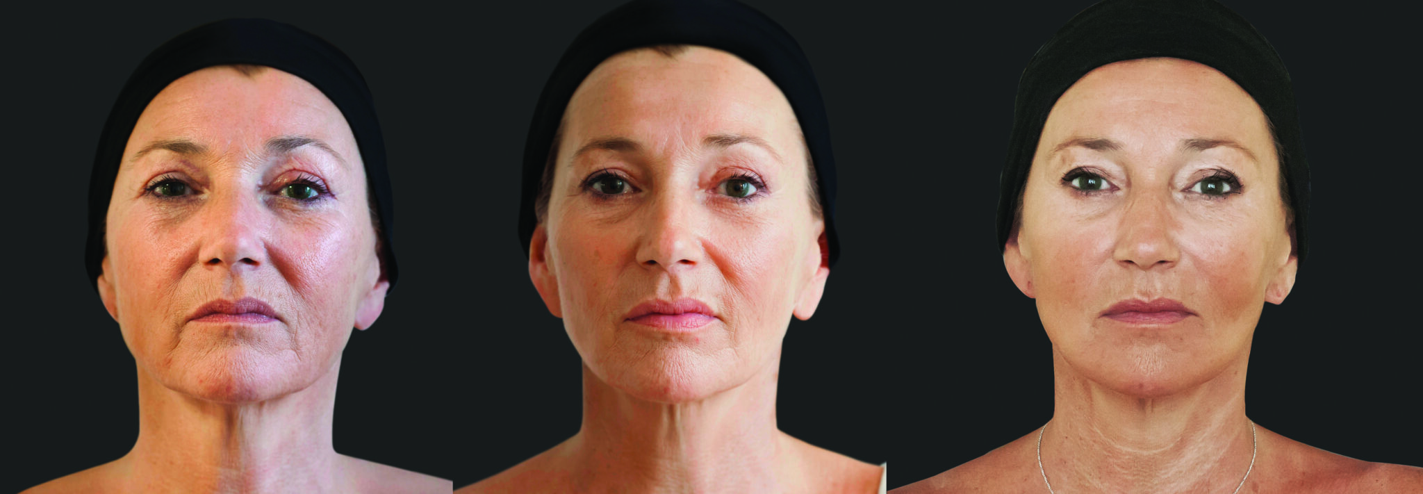 Non-surgical Jowl Lift | Thread Lift, HIFU, Injectables & Fillers for Jowl