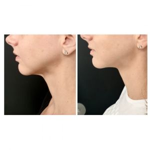 Discover Effective Turkey Neck Treatment Options in Brisbane