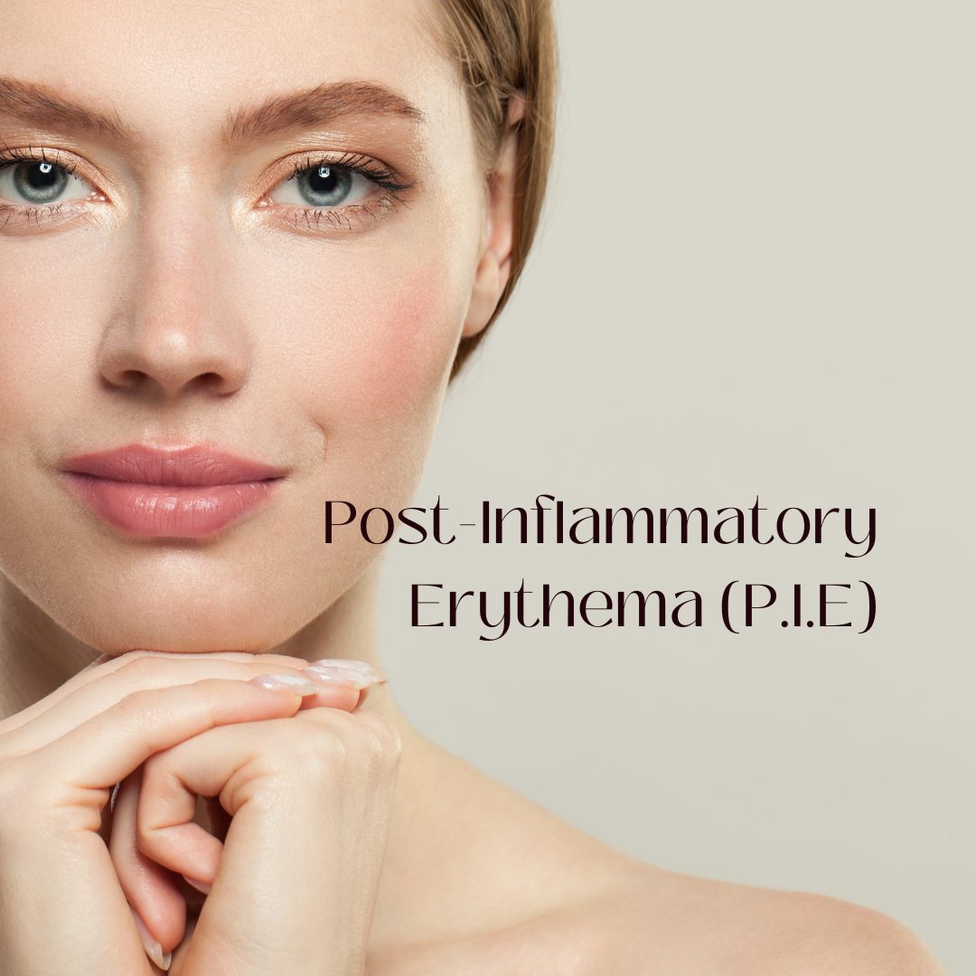 Post-Inflammatory Erythema (PIE) and Post-Inflammatory Redness