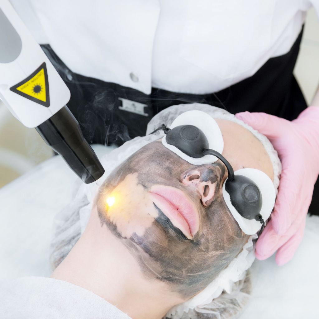 Carbon Laser Facial | Face Peel Laser Treatment | Laser Skin Peel