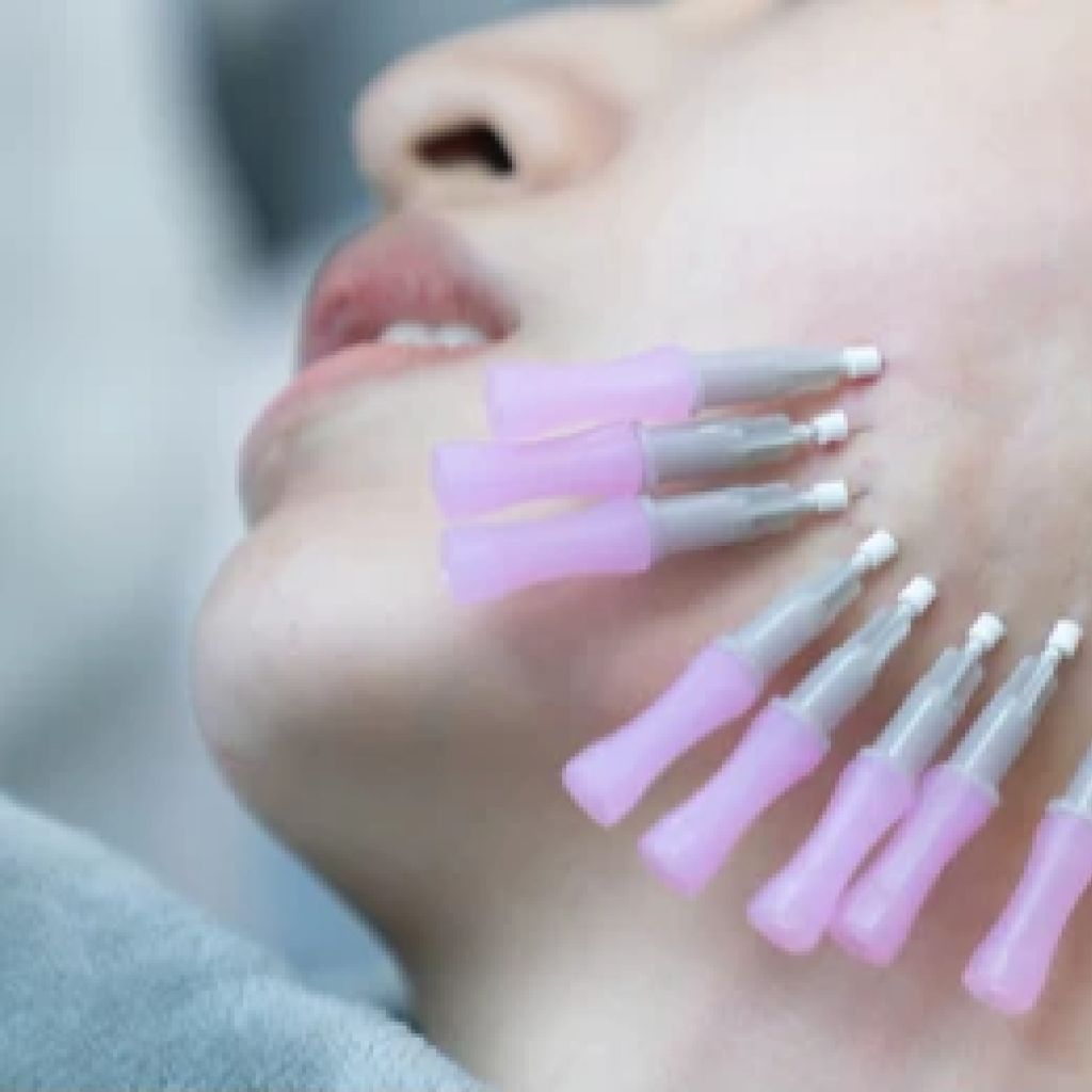 Thread Face Lift | PDO Mono Thread Lifts at Pearl Medispa Brisbane