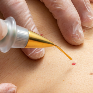 Cherry Angioma Removal | Red Moles on Skin | Red Cherry Spot Laser