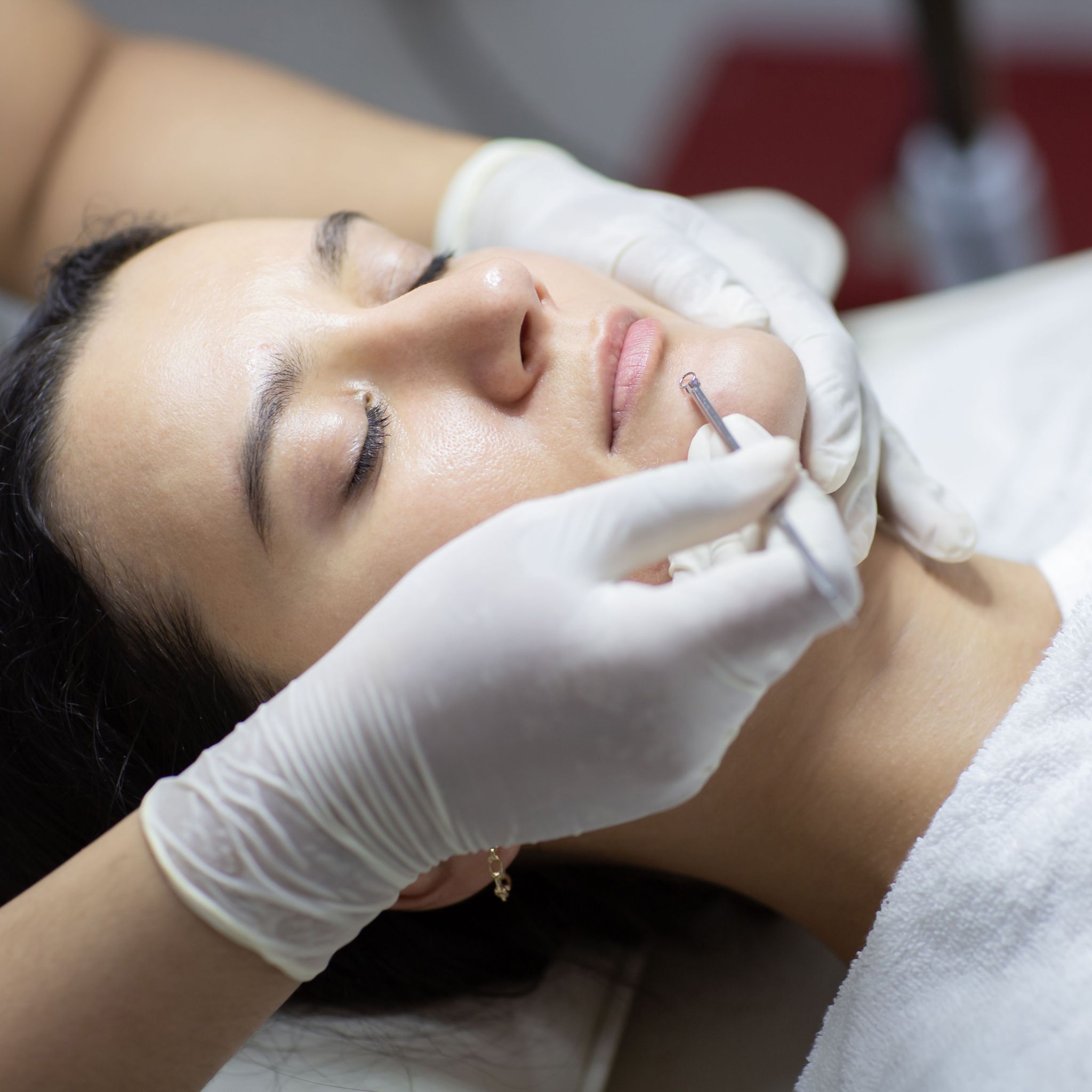 Extraction Facials | Blackhead Extraction, Milia, Pore & Pimple Extraction