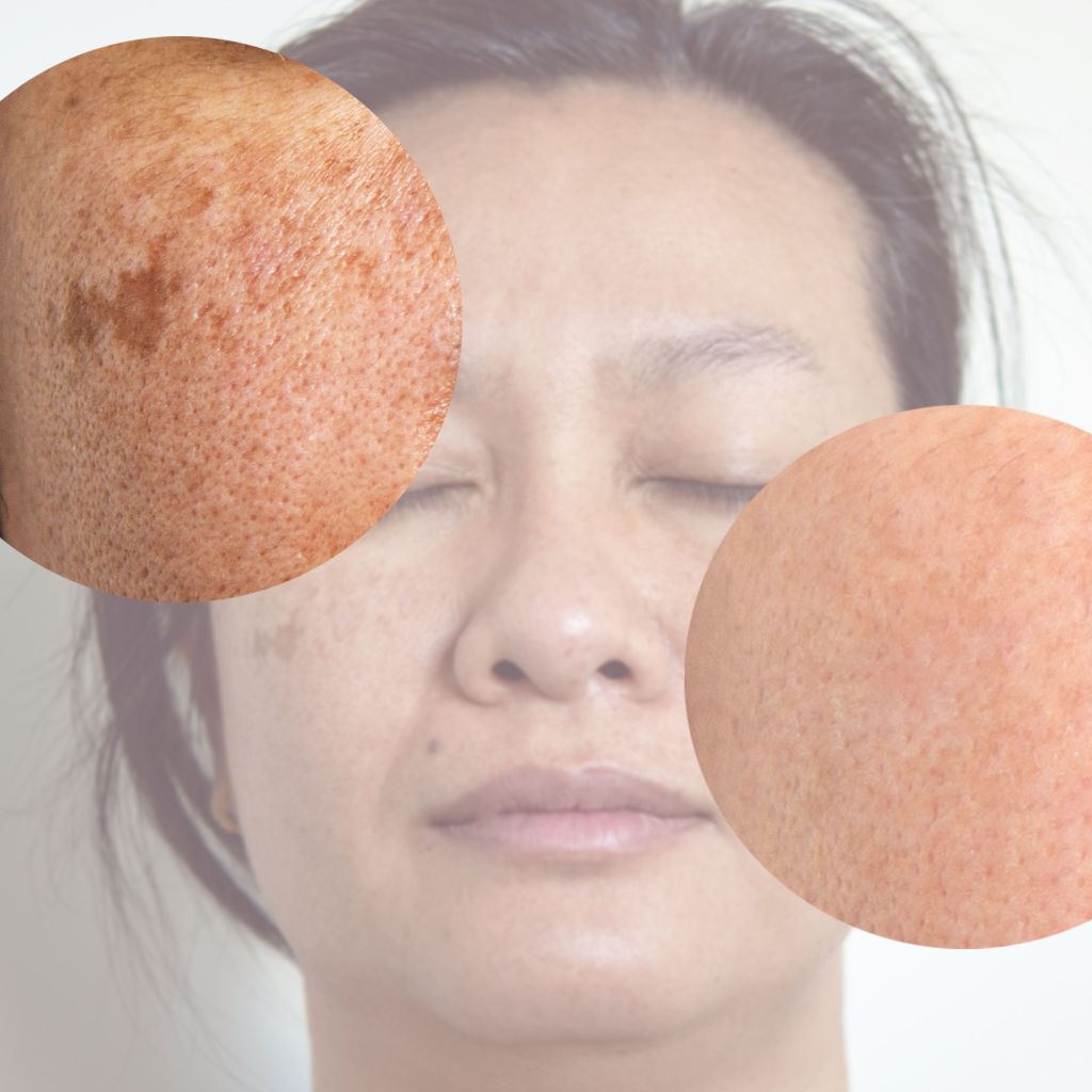 Pigmentation Facial| Laser and Photofacial Options for Even Skin Colour