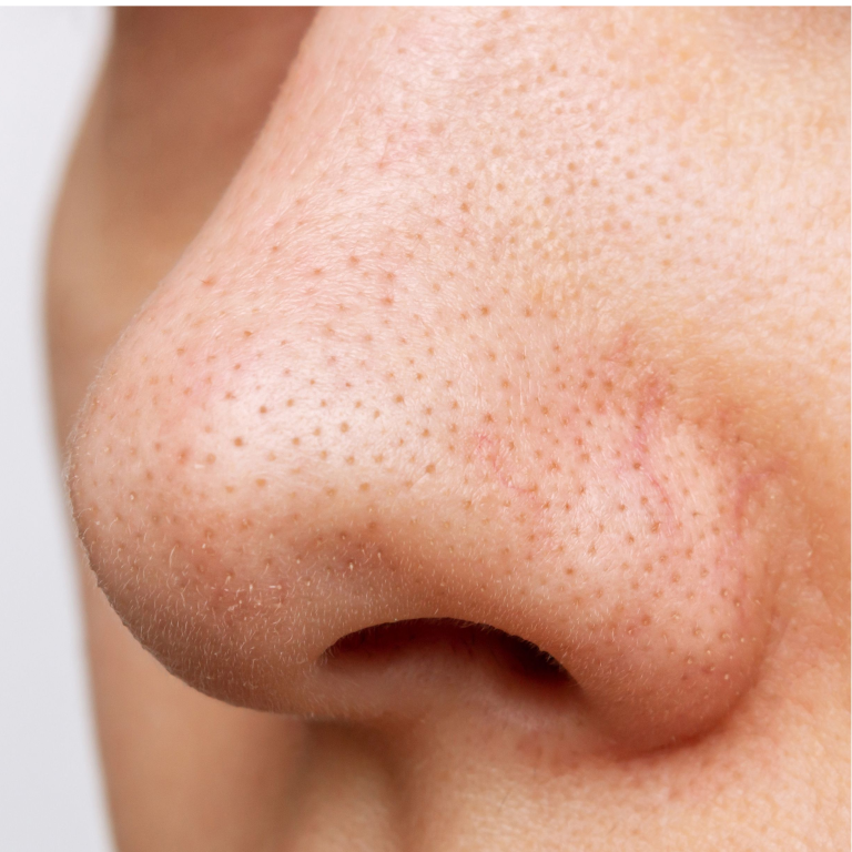 Sebaceous Filaments Treatment | Sebaceous Filaments vs Blackheads