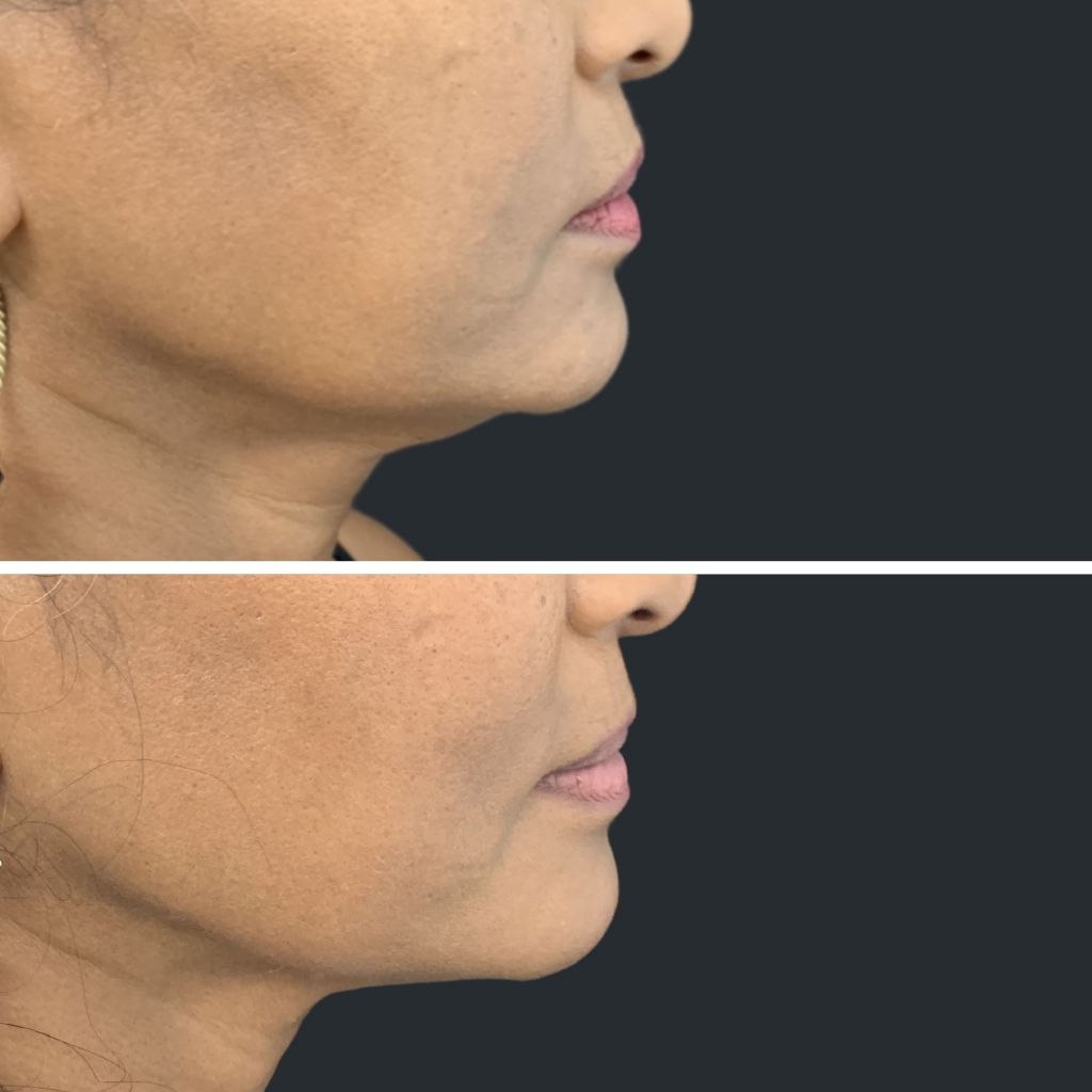 Thread Face Lift | PDO Mono Thread Lifts at Pearl Medispa Brisbane
