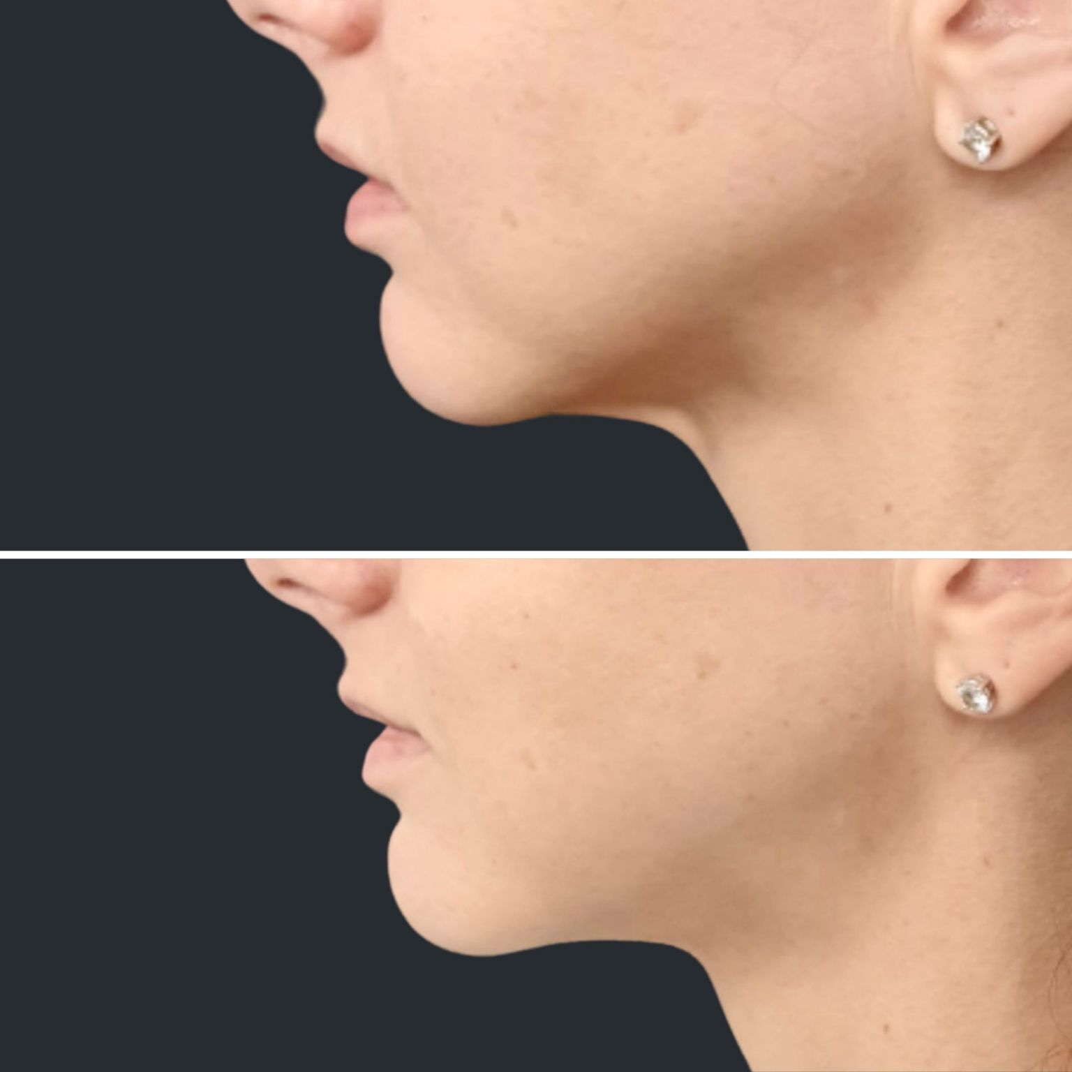 Thread Face Lift | PDO Mono Thread Lifts at Pearl Medispa Brisbane