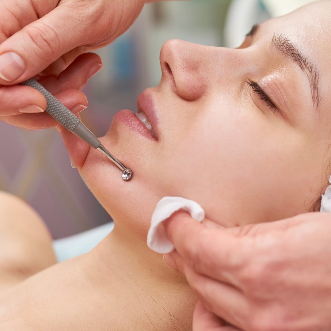 Milia Removal Brisbane | Professional Milia Extraction Facial