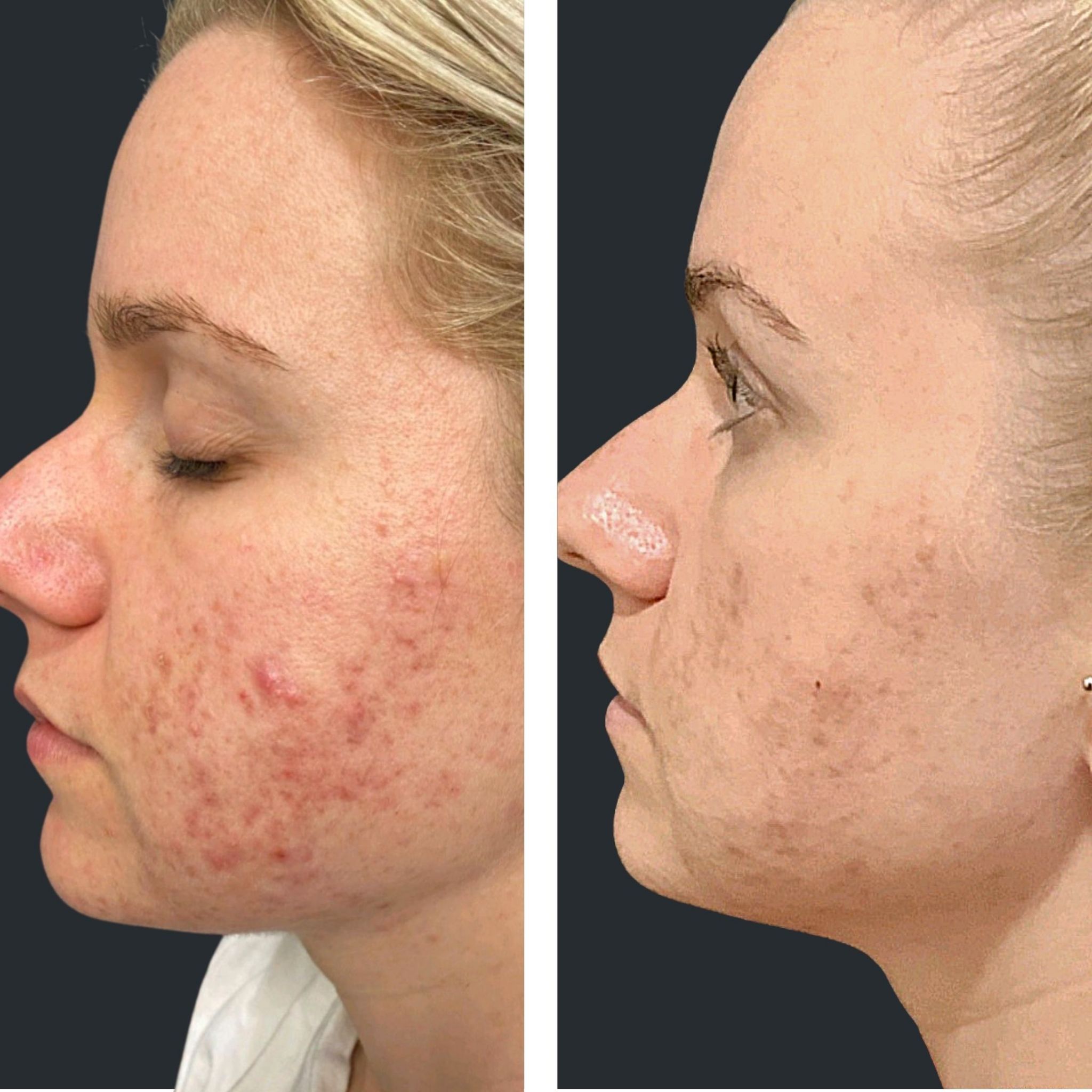 BBL Laser Brisbane | BBL Treatment - BBL Forever Young & BBL Facial