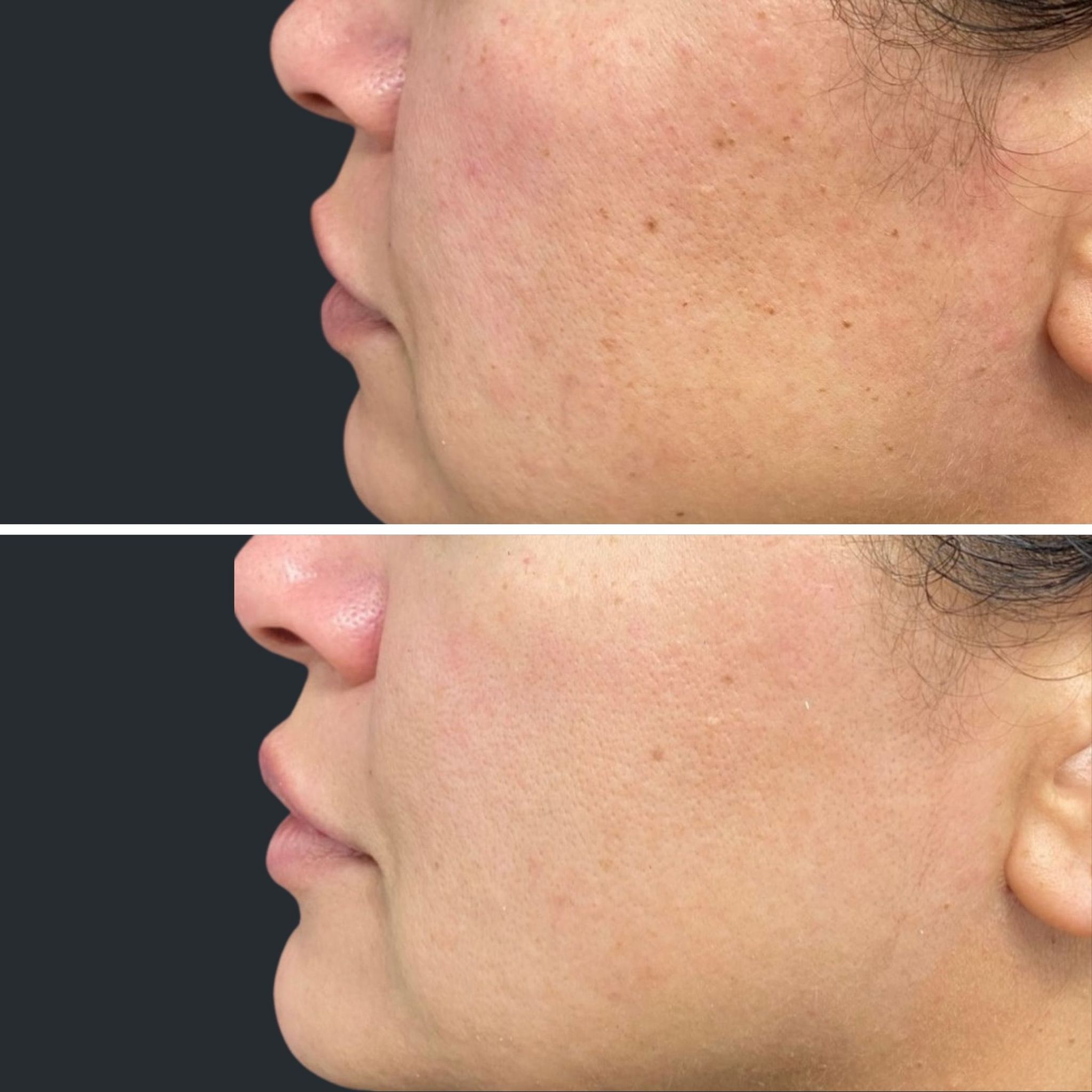 BBL Laser Brisbane | BBL Treatment - BBL Forever Young & BBL Facial