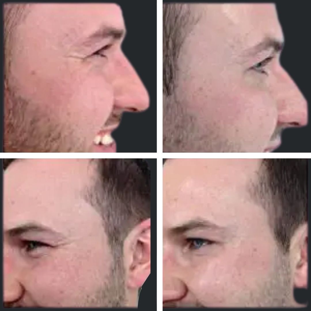 Laser for Eye Wrinkles | CO2, Pico and Tixel Laser for Under-Eye Wrinkles