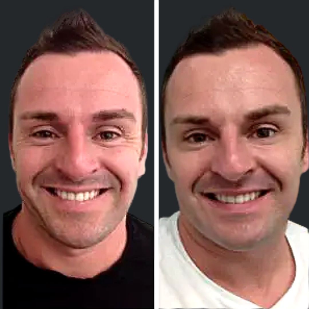 Laser for Eye Wrinkles | CO2, Pico and Tixel Laser for Under-Eye Wrinkles