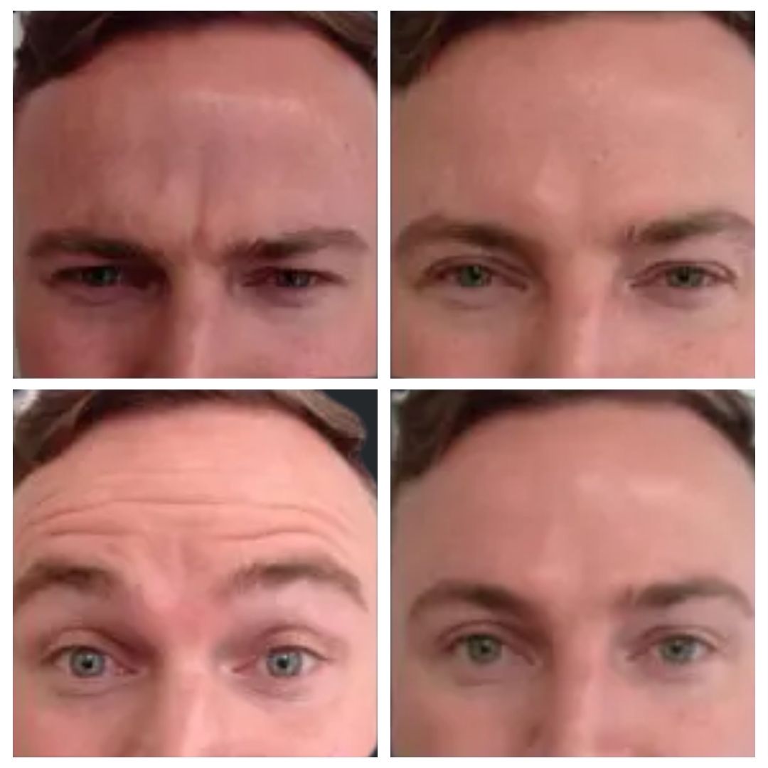 Forehead Wrinkles Treatment | Injections and Lasers for Forehead Lines