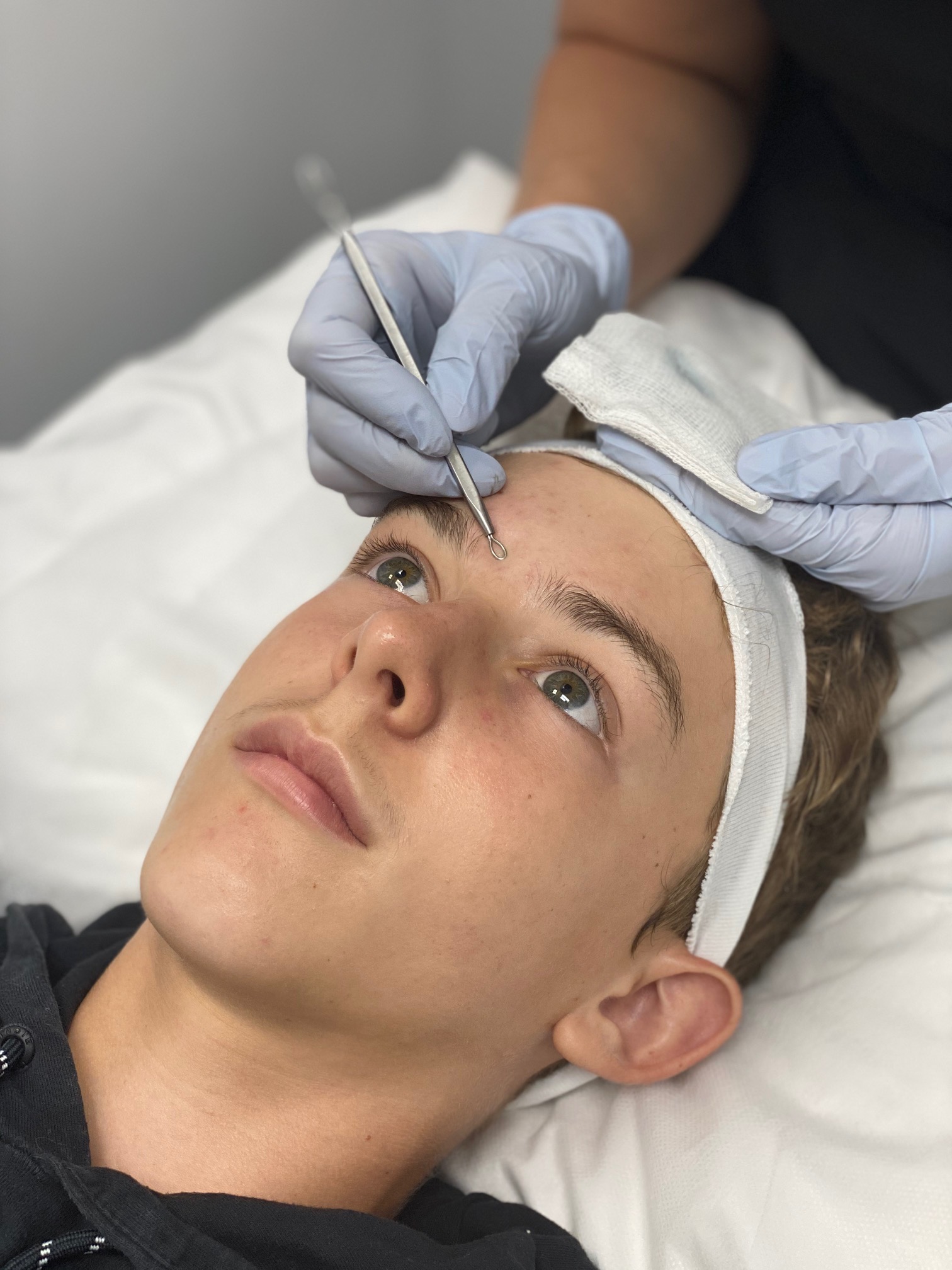 Extraction Facials | Blackhead Extraction, Milia, Pore & Pimple Extraction