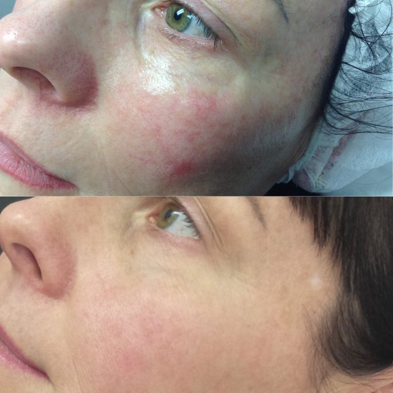 Broken Capillaries on Face | IPL for Broken Capillaries on Face | IPL Nose