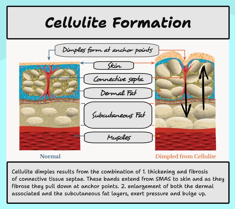 Cellulite Subcision Brisbane | Manual Subcision, Cellulaze, Cellfina, QWO