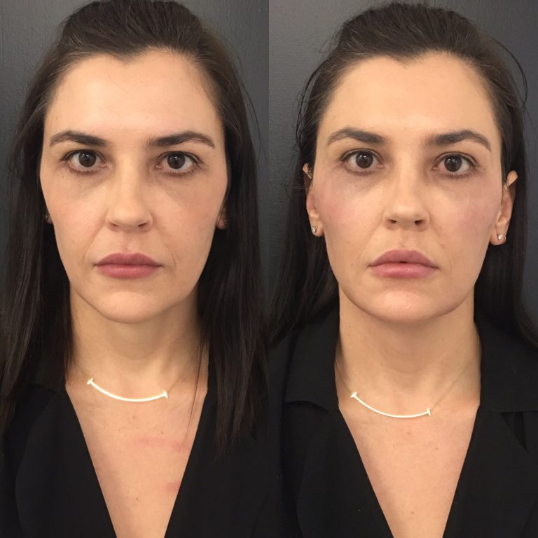 Cheek Filler Brisbane | Cheek Dermal Fillers and Biostimulator Injections