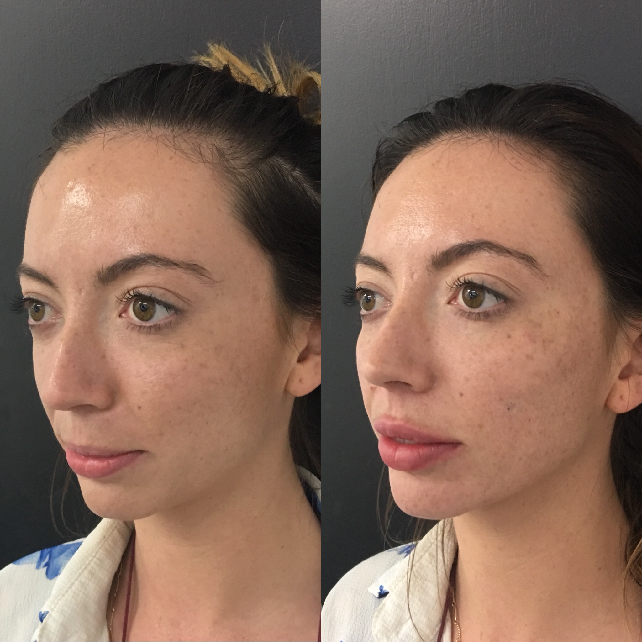 Chin Filler Brisbane | Weak Chin, Chin Wrinkles, Crease or Marionette Line