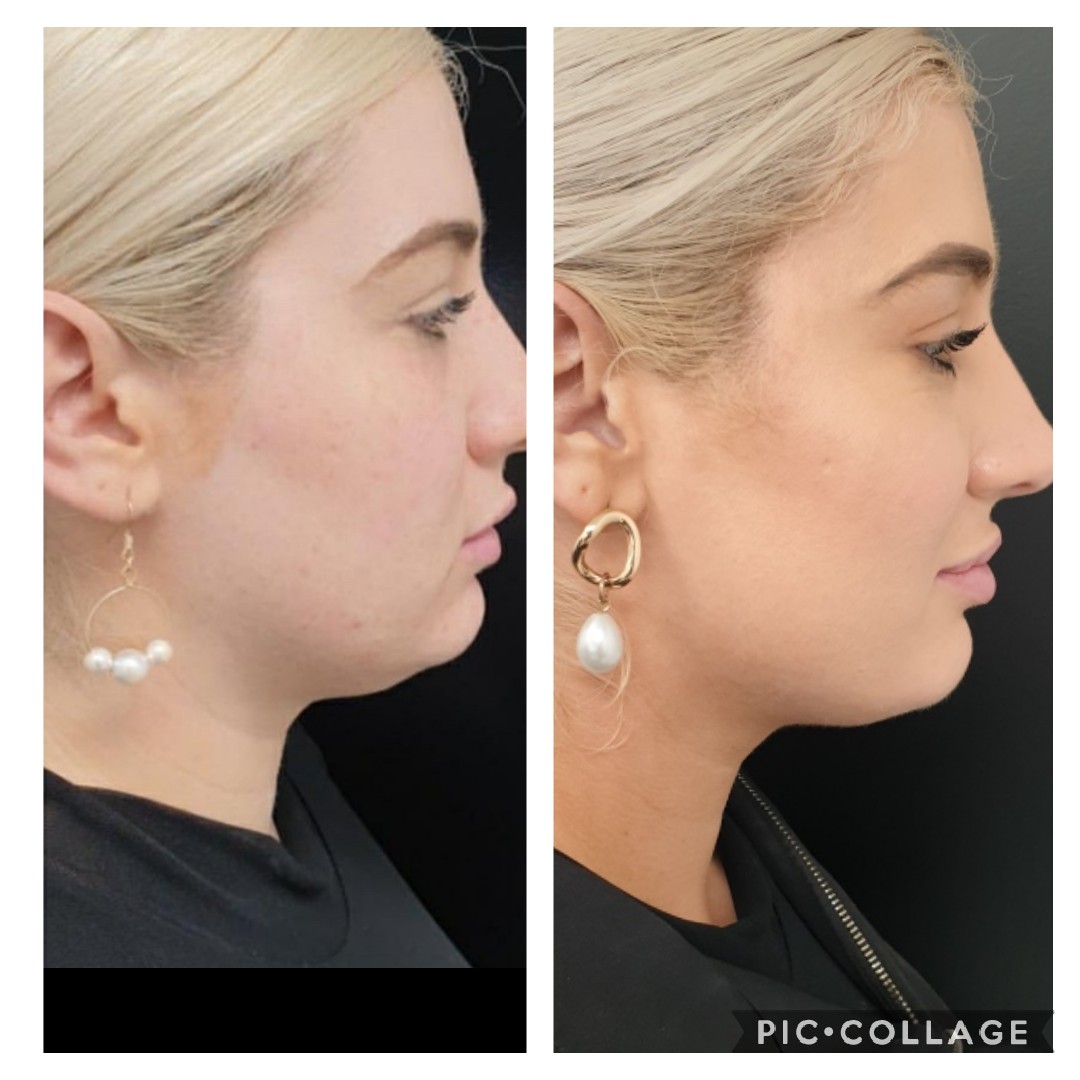 Non-surgical Neck Lift | Neck Tightening, Nefertiti Lift and Neck ...