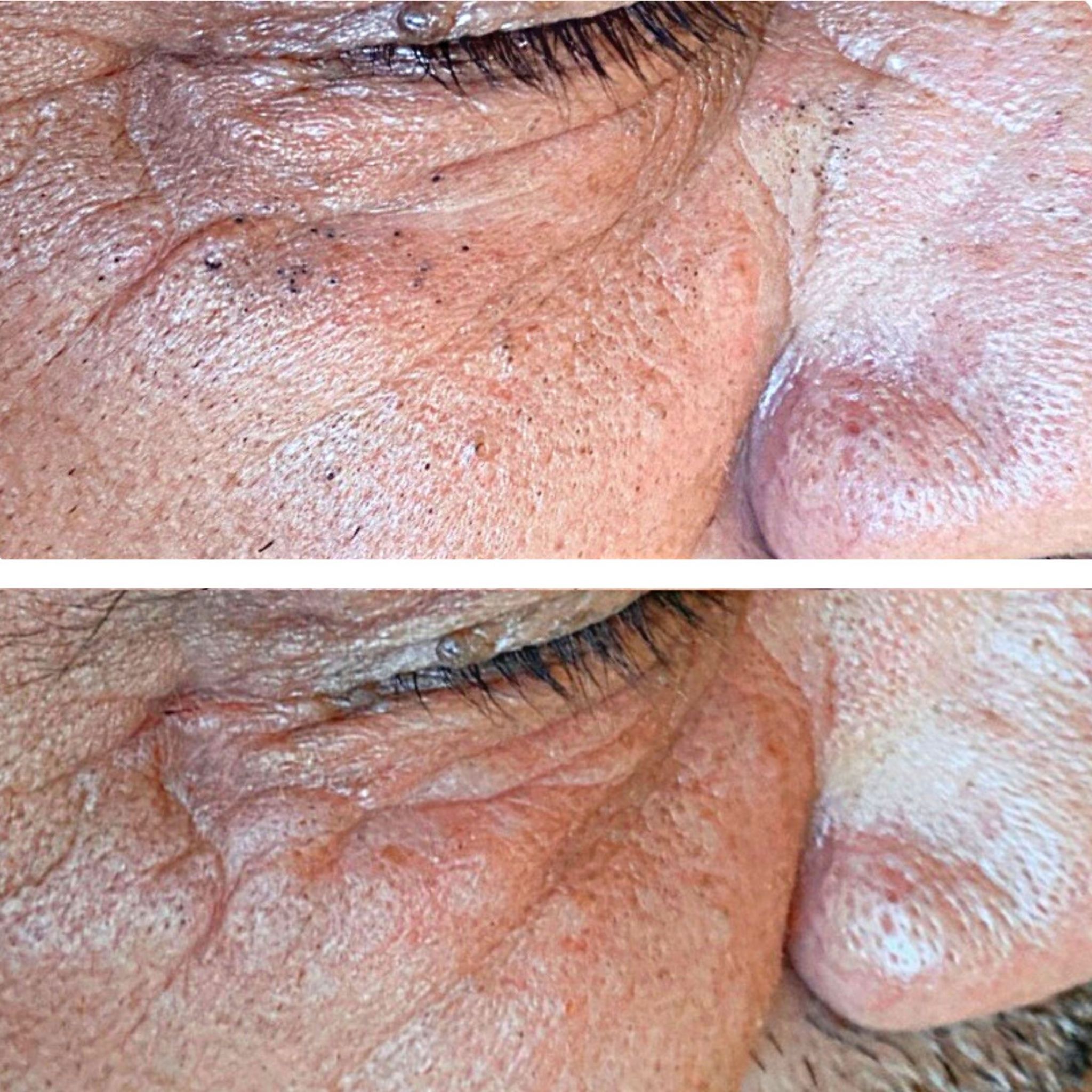 Extraction Facials | Blackhead Extraction, Milia, Pore & Pimple Extraction