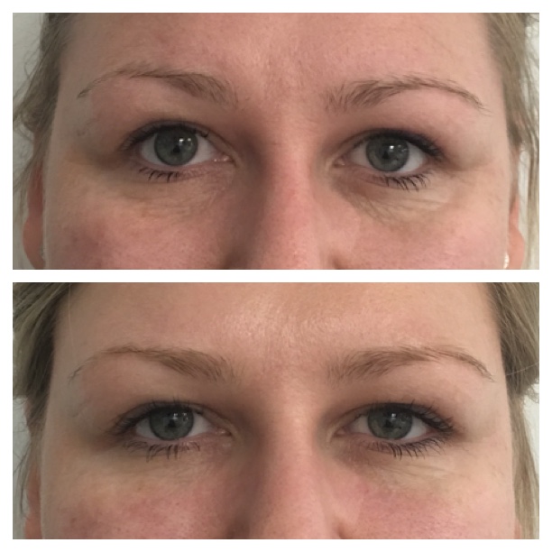 Laser for Eye Wrinkles | CO2, Pico and Tixel Laser for Under-Eye Wrinkles