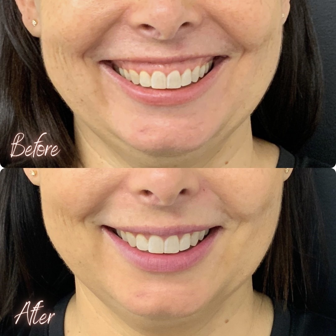 Gummy Smile Treatment Brisbane | Anti-Wrinkle Injections Gummy Smile