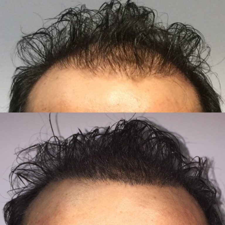 Hair Tattoo for Baldness | Scalp Micropigmentation and Hairline Tattoo