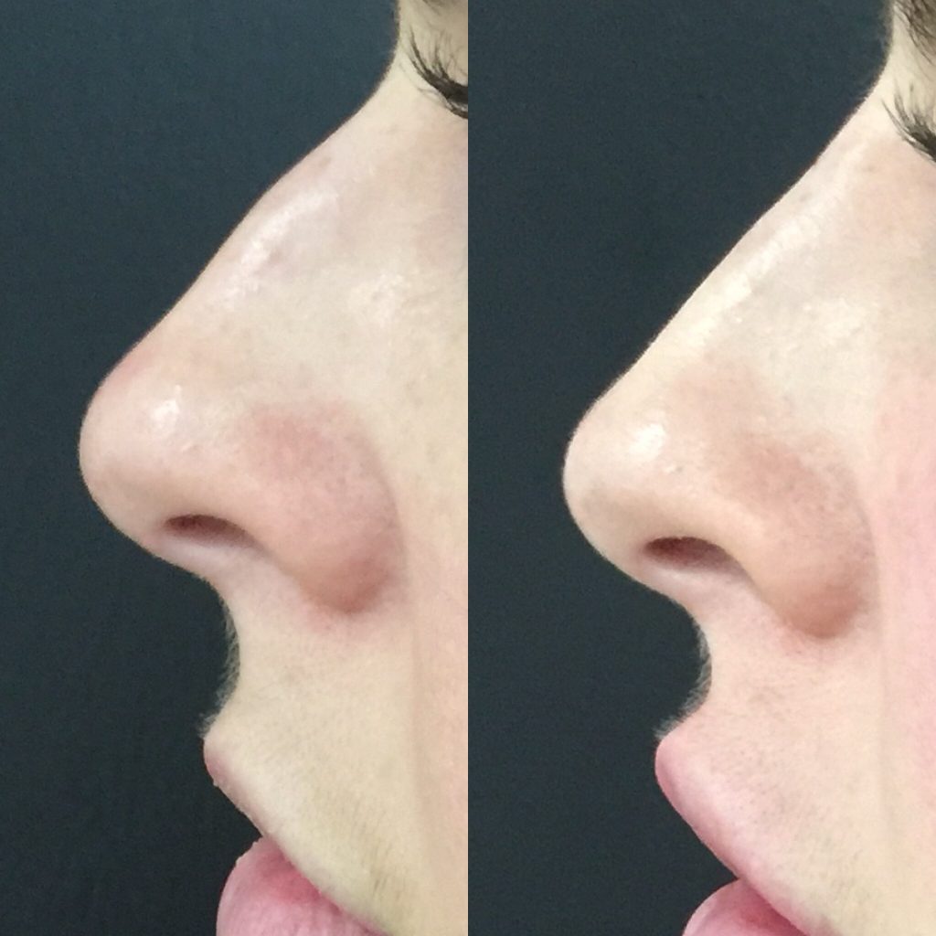 Non-Surgical Rhinoplasty | Nose Shaper, Nose Filler or Hiko Nose Thread