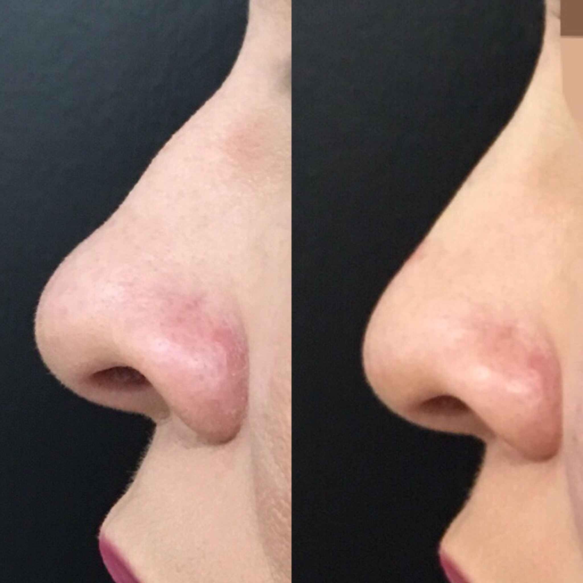 Non-Surgical Rhinoplasty with Nose Filler or Nose Thread Lift (Hiko Nose)