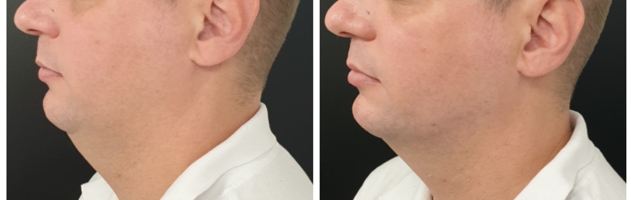 Non-surgical Neck Lift | Neck Tightening, Nefertiti Lift and Neck ...