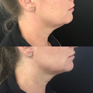 Non-surgical Jowl Lift | Jowl Treatment to Tighten Jowls, Filler for Jowls