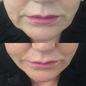 Non-surgical Jowl Lift | Thread Lift, HIFU, Injectables & Fillers for Jowl