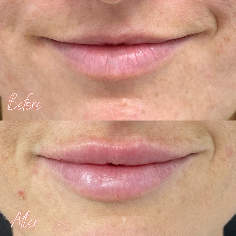 Lip Flip Brisbane | Lip Anti-Wrinkle Injections for Fuller Lips or Lip ...