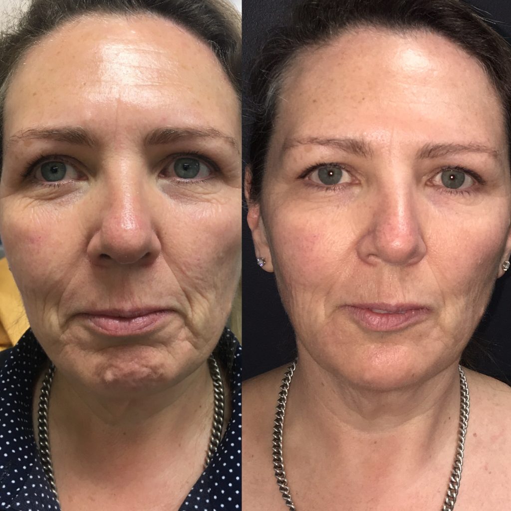 Non-surgical Jowl Lift | Thread Lift, HIFU, Injectables & Fillers for Jowl