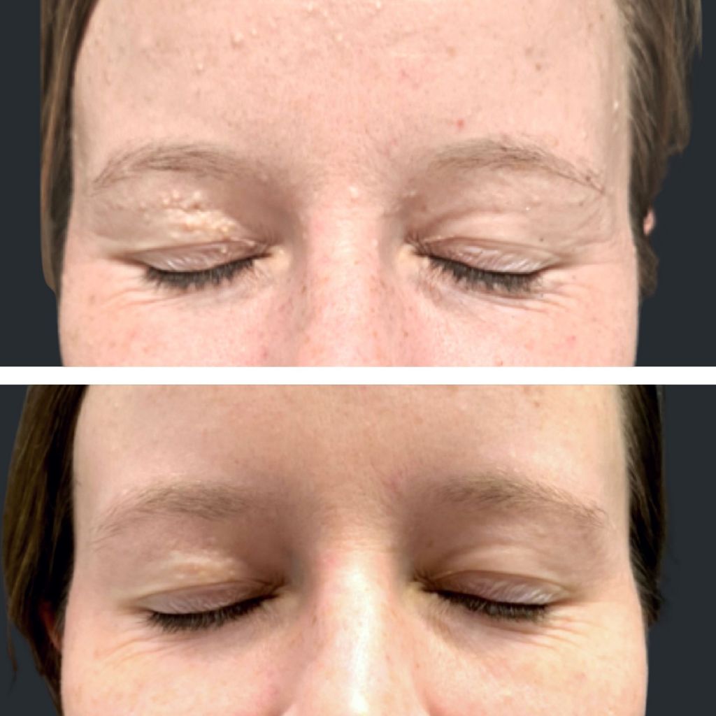 Milia Removal the Right Way with Our Milia Extraction Facial