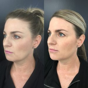 Non-surgical Jowl Lift | Thread Lift, HIFU, Injectables & Fillers for Jowl