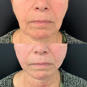 Non-surgical Jowl Lift | Thread Lift, HIFU, Injectables & Fillers for Jowl