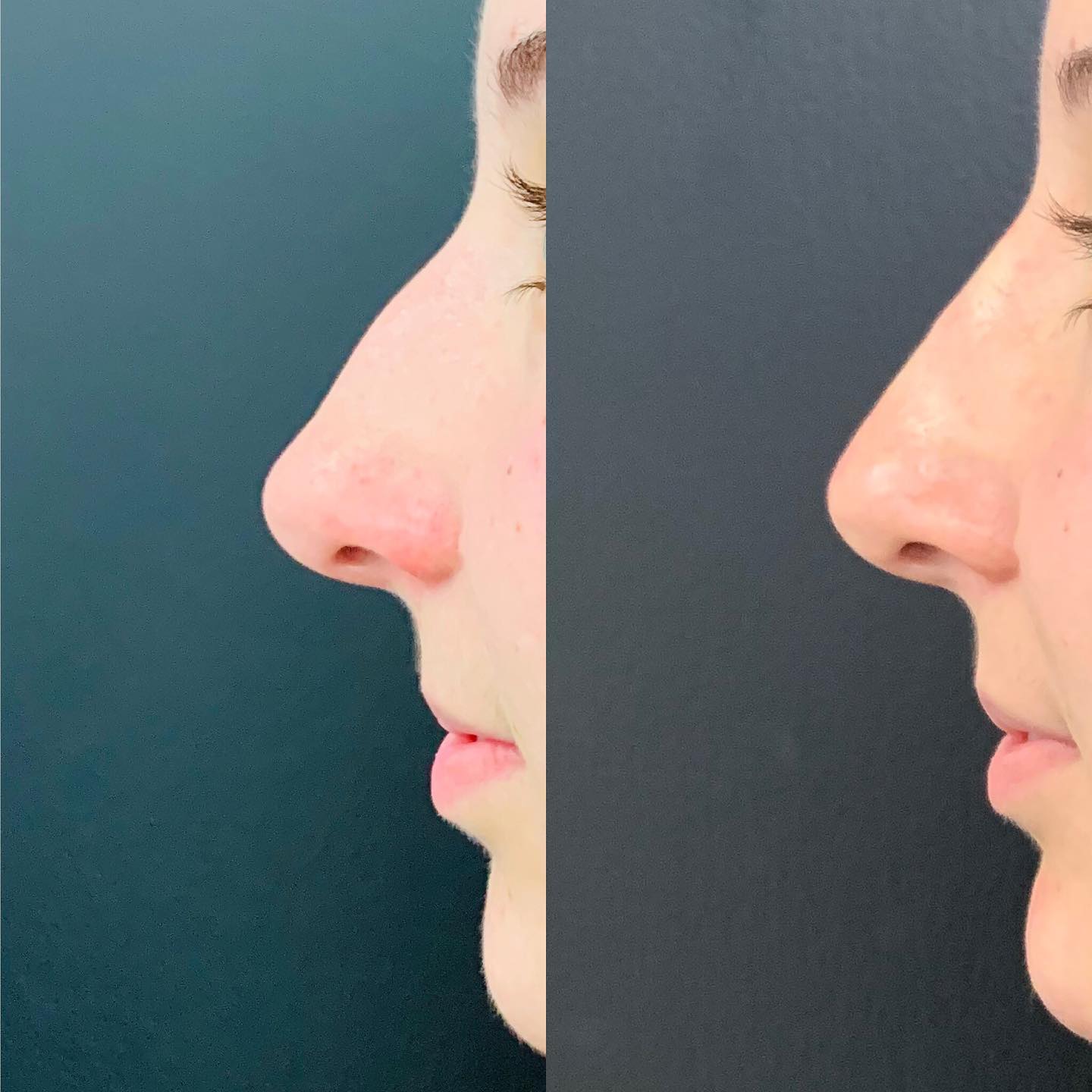Non-Surgical Rhinoplasty | Nose Shaper, Nose Filler or Hiko Nose Thread
