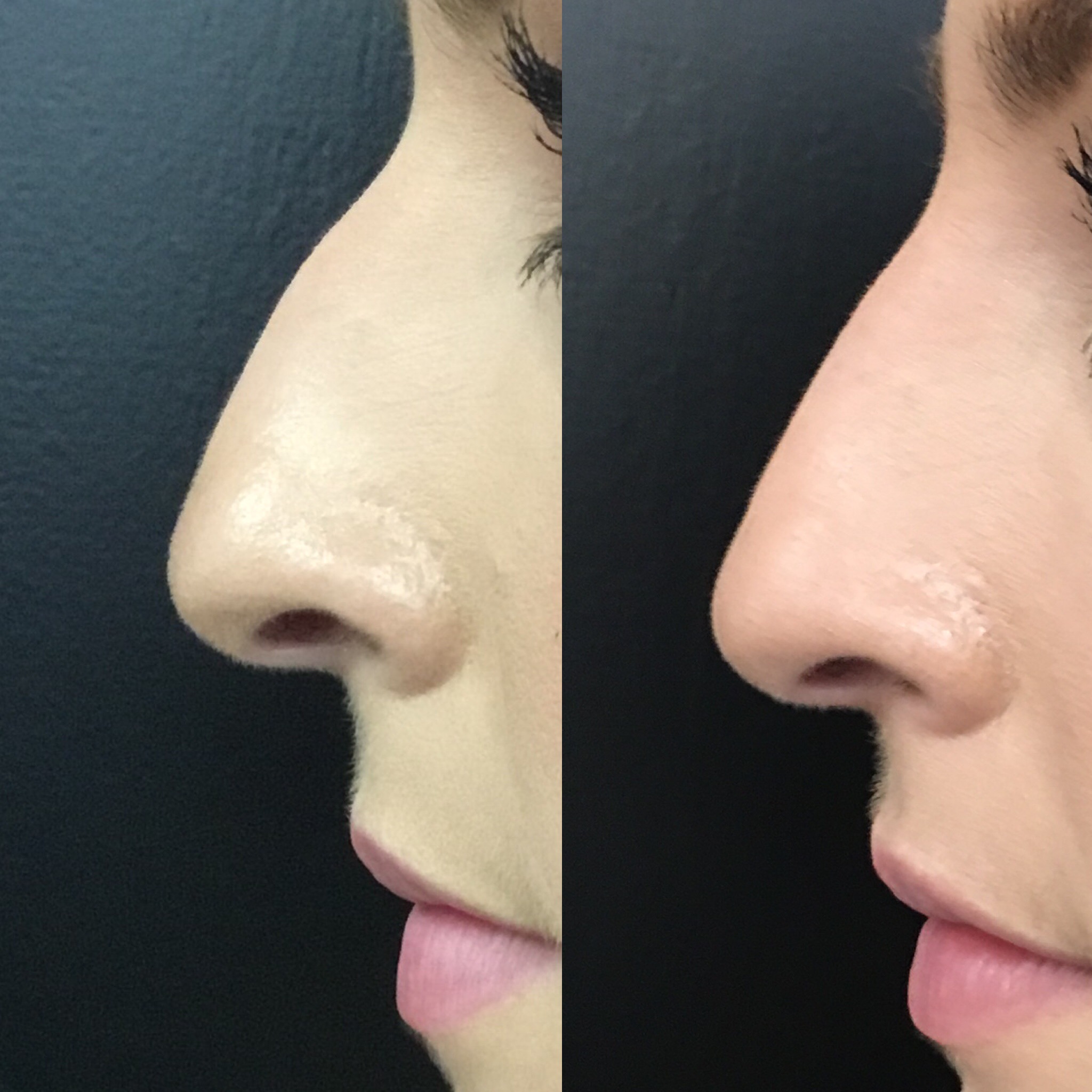 Non-Surgical Rhinoplasty | Nose Shaper, Nose Filler or Hiko Nose Thread