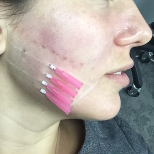 Thread Face Lift | PDO Thread Lift, Nose & Eye Thread, Mono Threads.