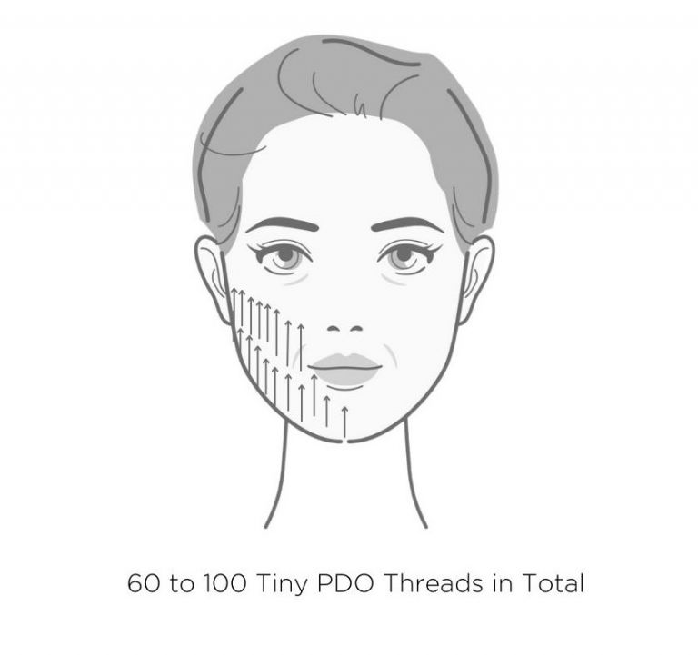 Non-surgical Jowl Lift | Thread Lift, HIFU, Injectables & Fillers for Jowl