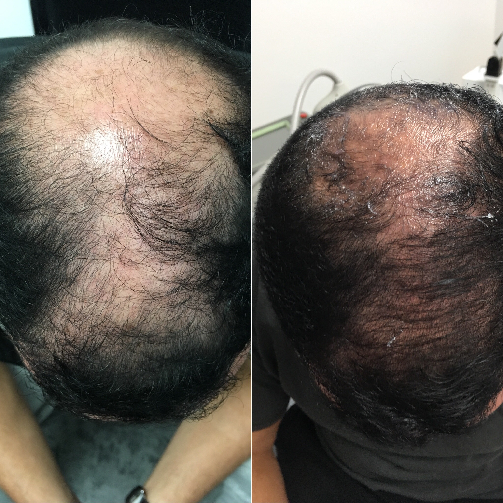 PRP Hair Treatment Brisbane | Platelet-Rich Plasma for Hair Loss